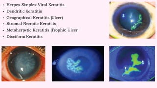 KERATITIS.pptx