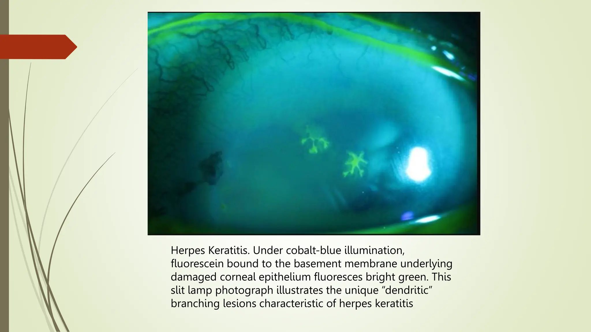 Keratitis treatment and management for adult and children | PPTX