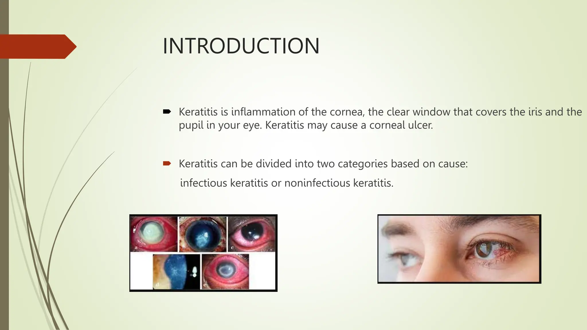 Keratitis treatment and management for adult and children | PPTX