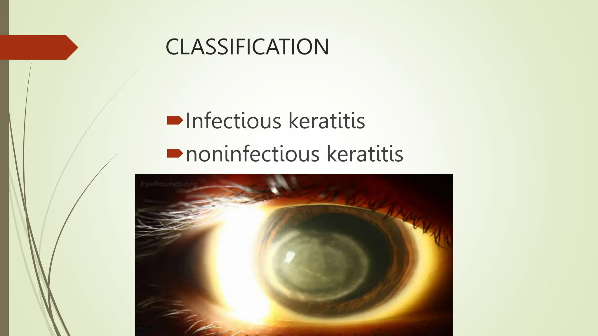 Keratitis treatment and management for adult and children | PPTX