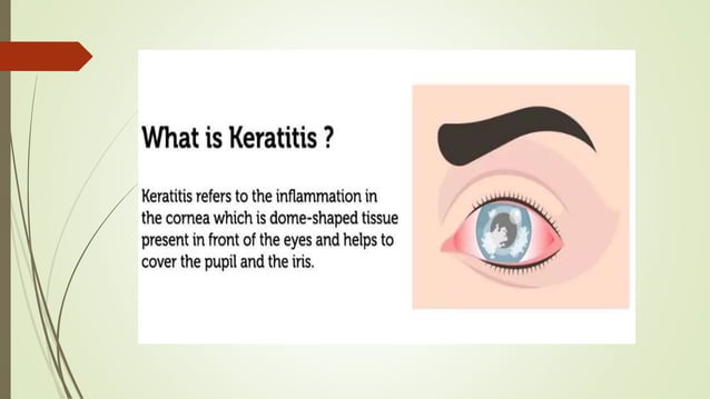 Keratitis treatment and management for adult and children | PPTX