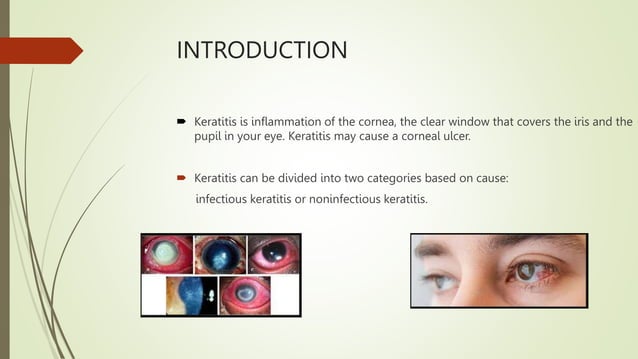 Keratitis treatment and management for adult and children | PPTX