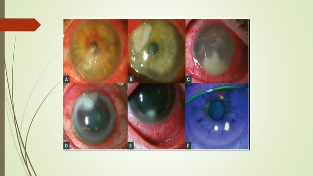 Keratitis treatment and management for adult and children | PPTX
