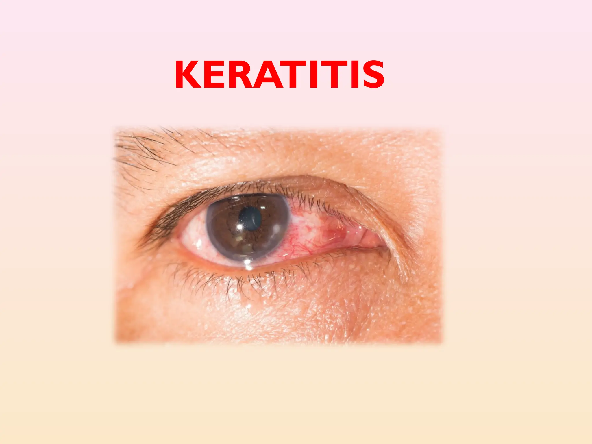 Keratitis, also known as corneal ulcer, is an inflammation of the ...