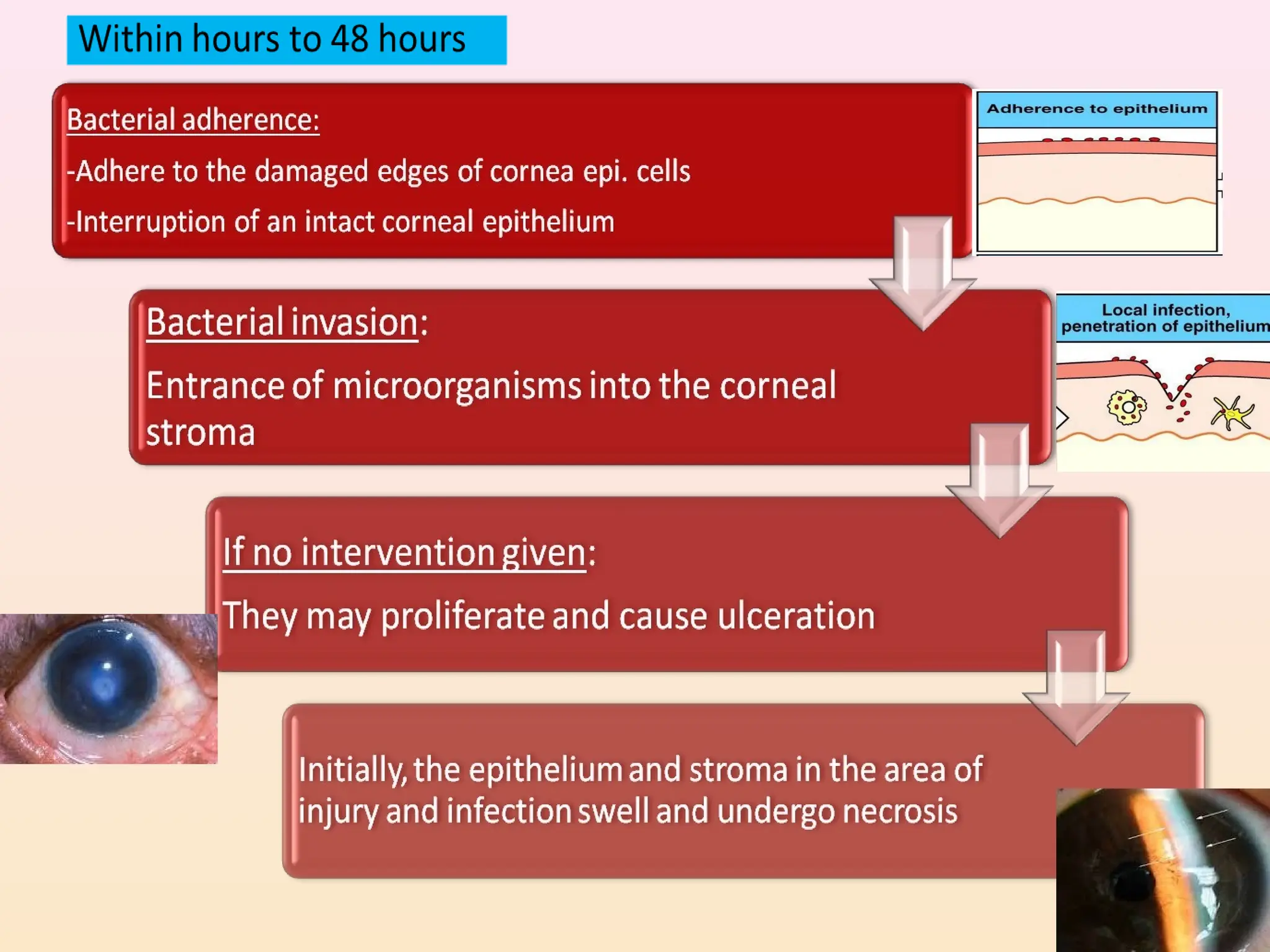Keratitis, also known as corneal ulcer, is an inflammation of the ...