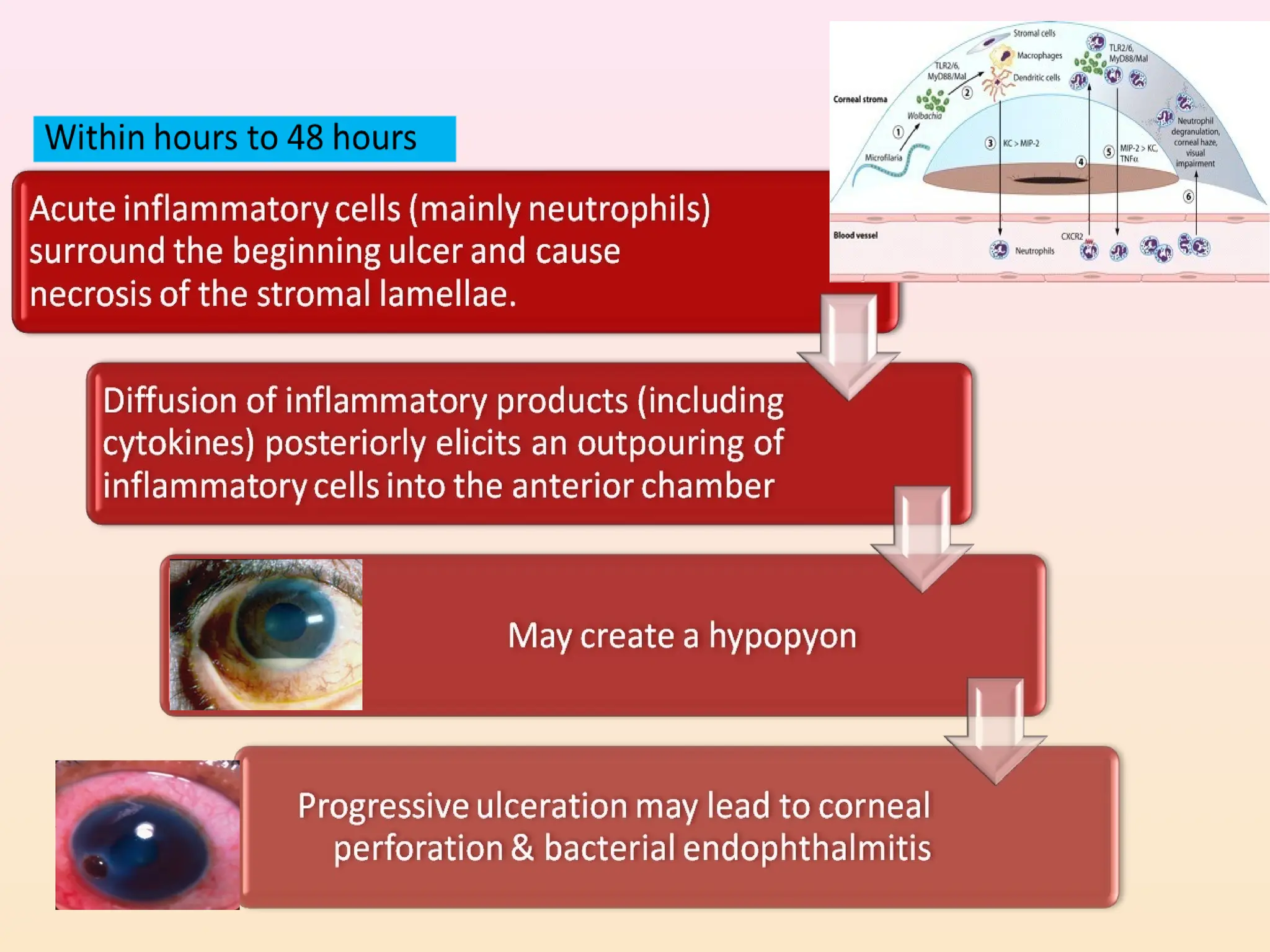 Keratitis, also known as corneal ulcer, is an inflammation of the ...
