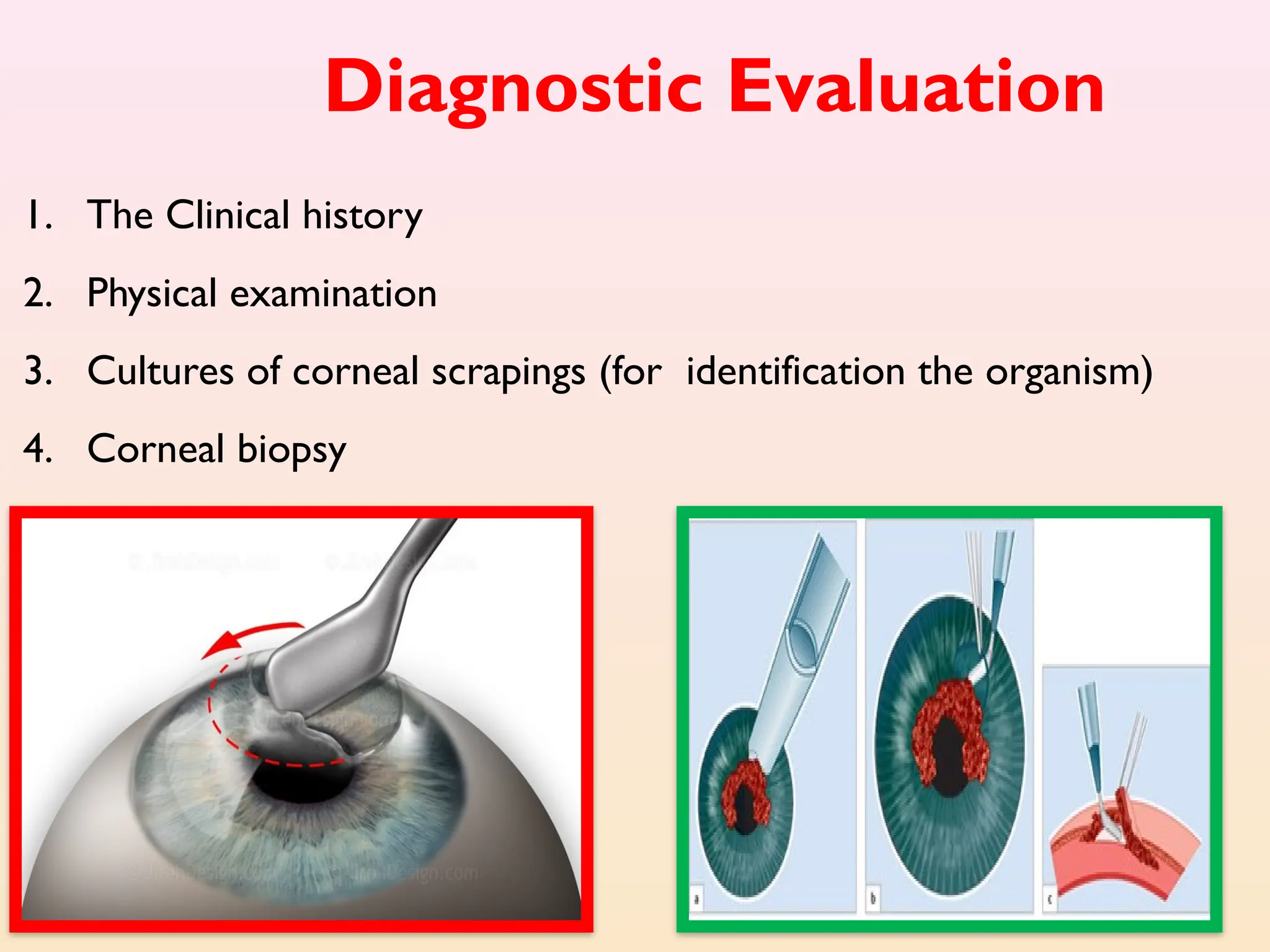 Keratitis, also known as corneal ulcer, is an inflammation of the ...