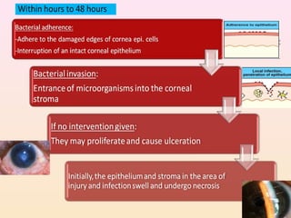 Keratitis, also known as corneal ulcer, is an inflammation of the ...