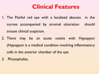 Keratitis, also known as corneal ulcer, is an inflammation of the ...
