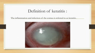 Nursing management of keratitis patient.pptx