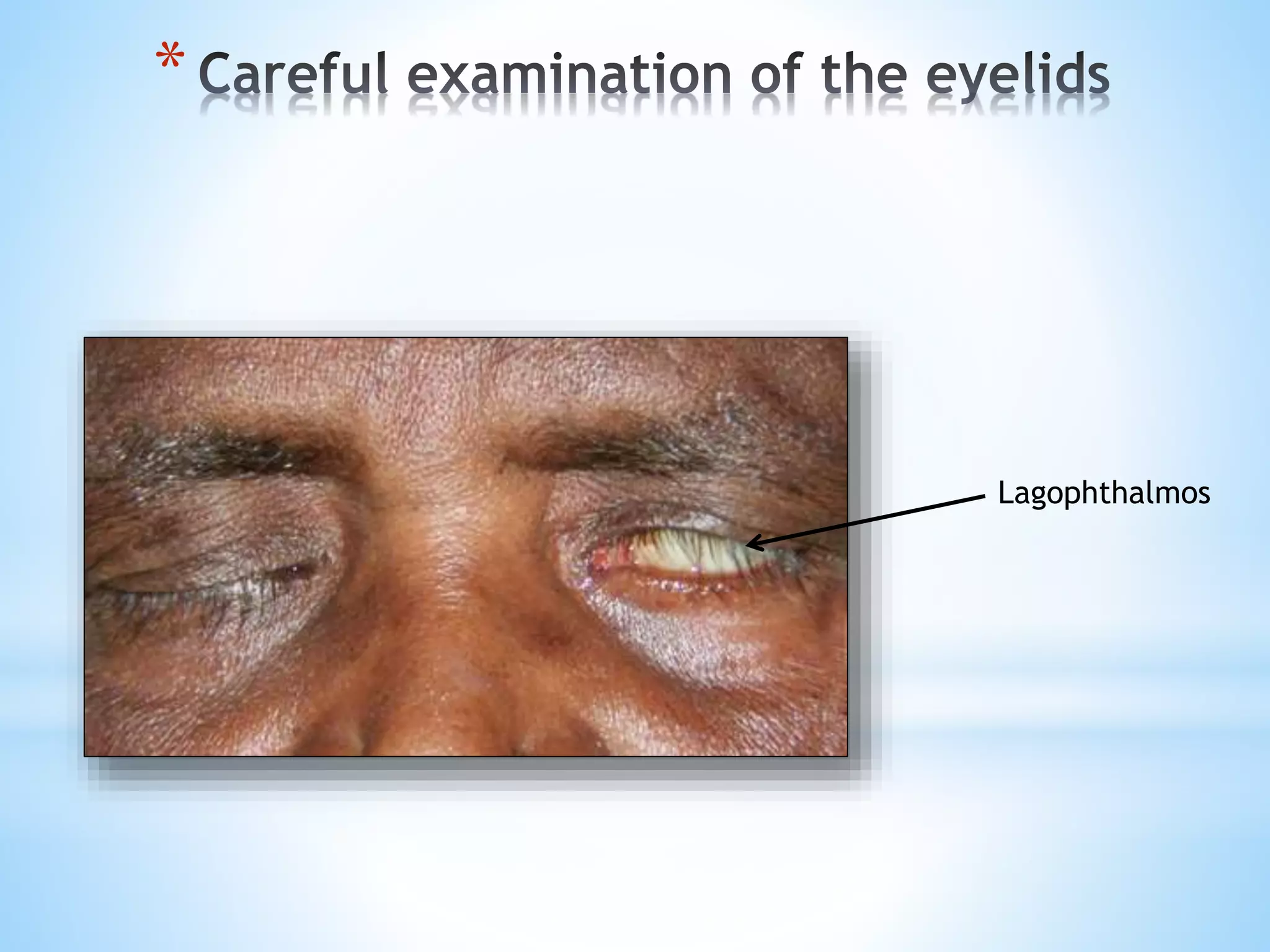 Approach To Microbial Keratitis - 1 | PPTX