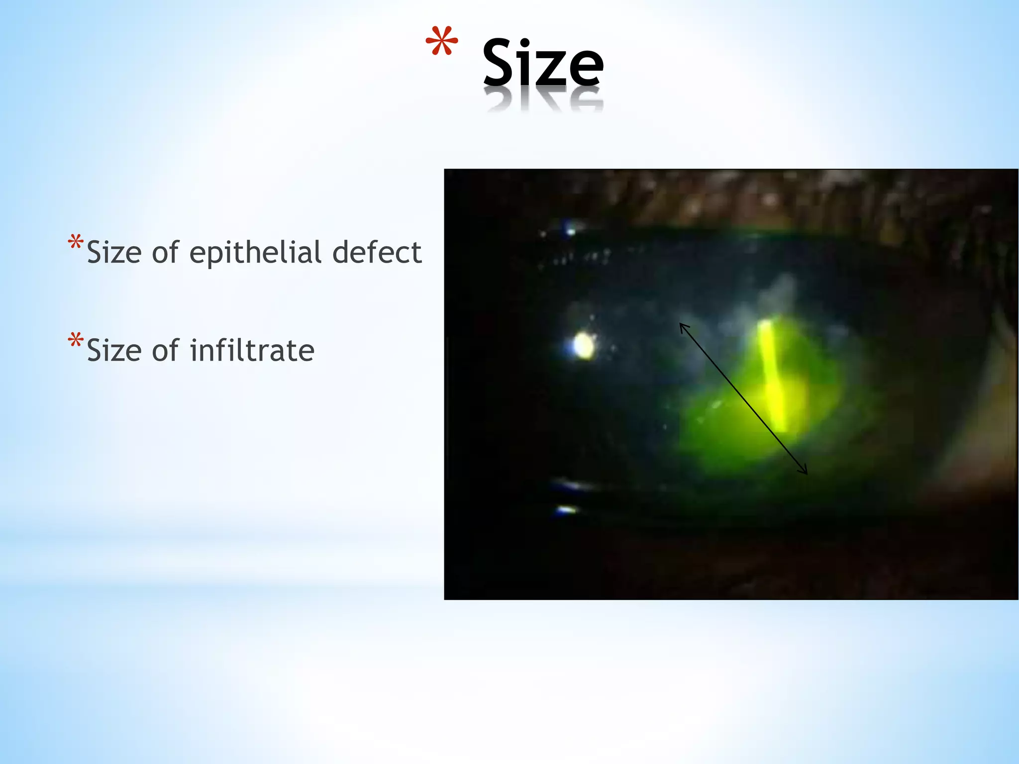 Approach To Microbial Keratitis - 1 | PPTX