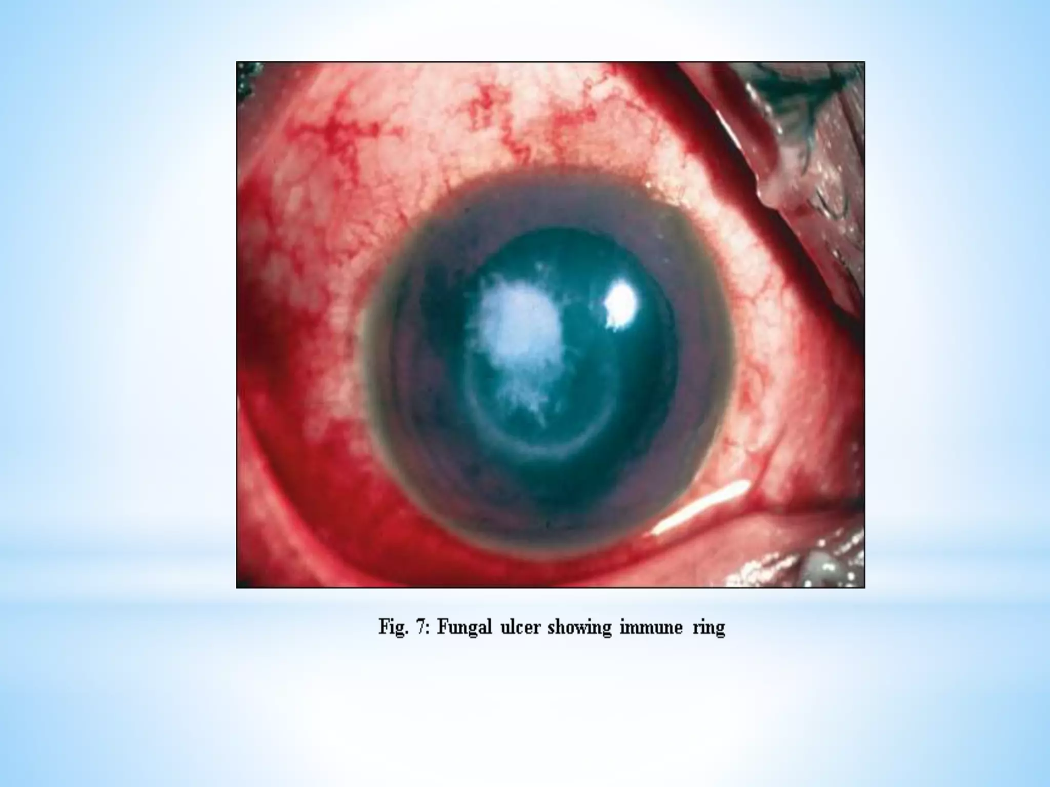 Approach To Microbial Keratitis - 1 | PPTX
