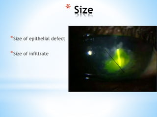 Approach To Microbial Keratitis - 1 | PPT