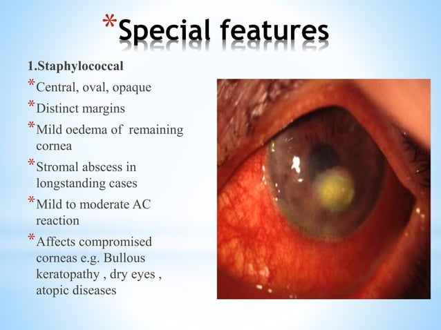 Approach To Microbial Keratitis - 1 | PPT