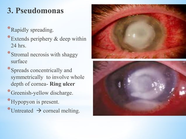 Approach To Microbial Keratitis - 1 | PPT