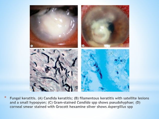 Approach To Microbial Keratitis - 1 | PPT