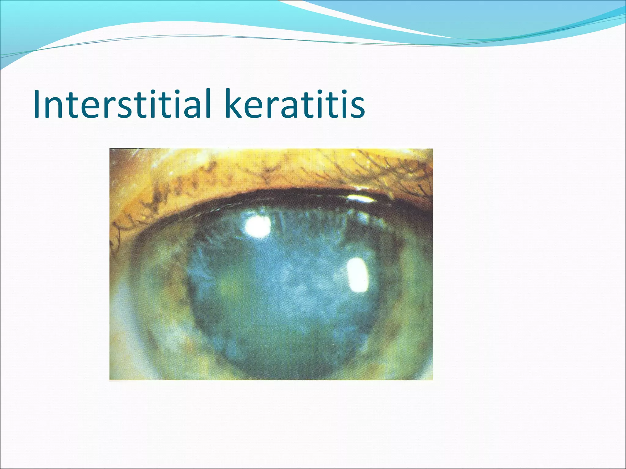 Keratitis | PPT