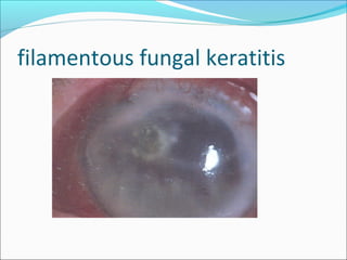 Keratitis | PPT
