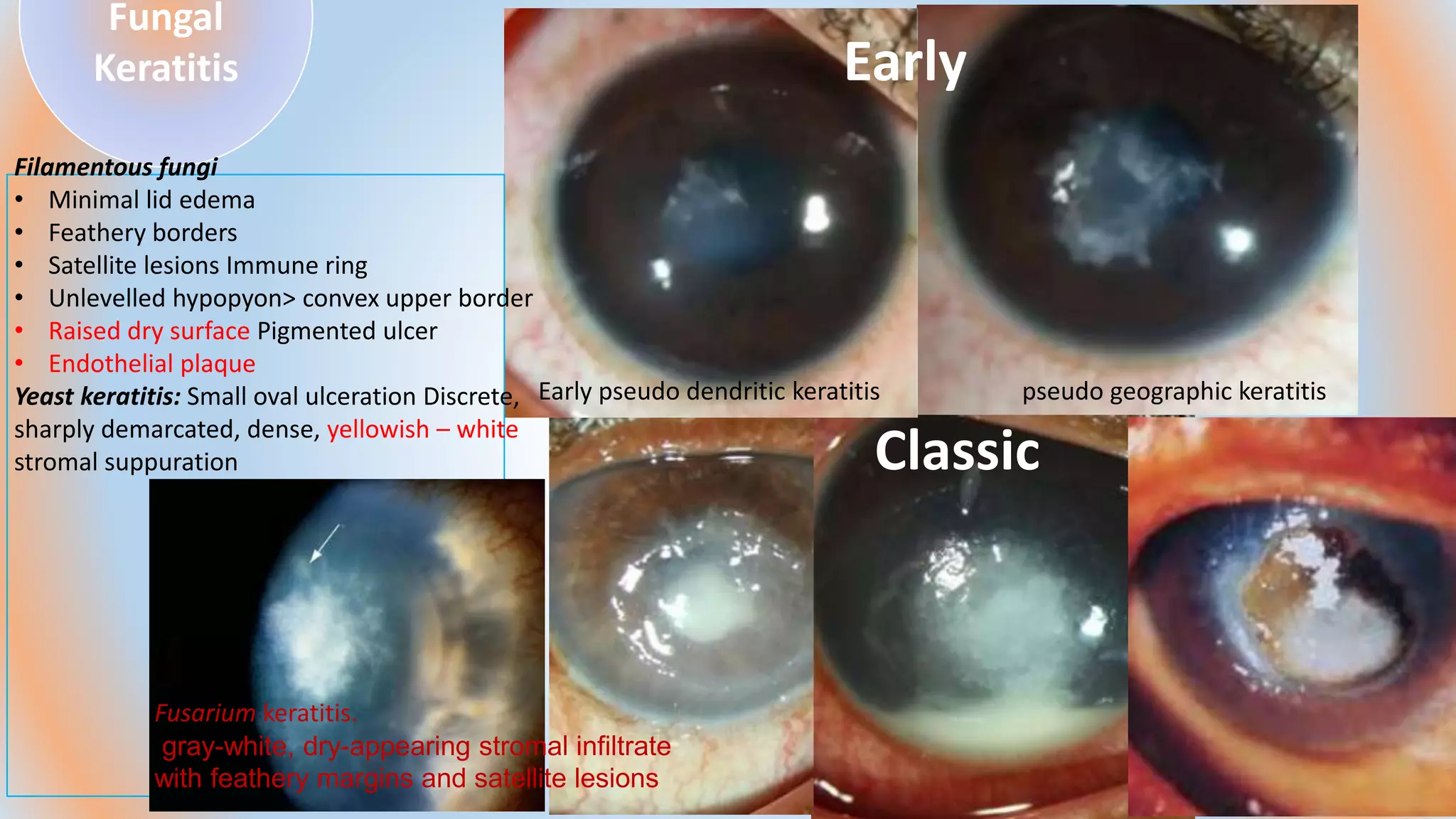 keratitis [Autosaved].pptx