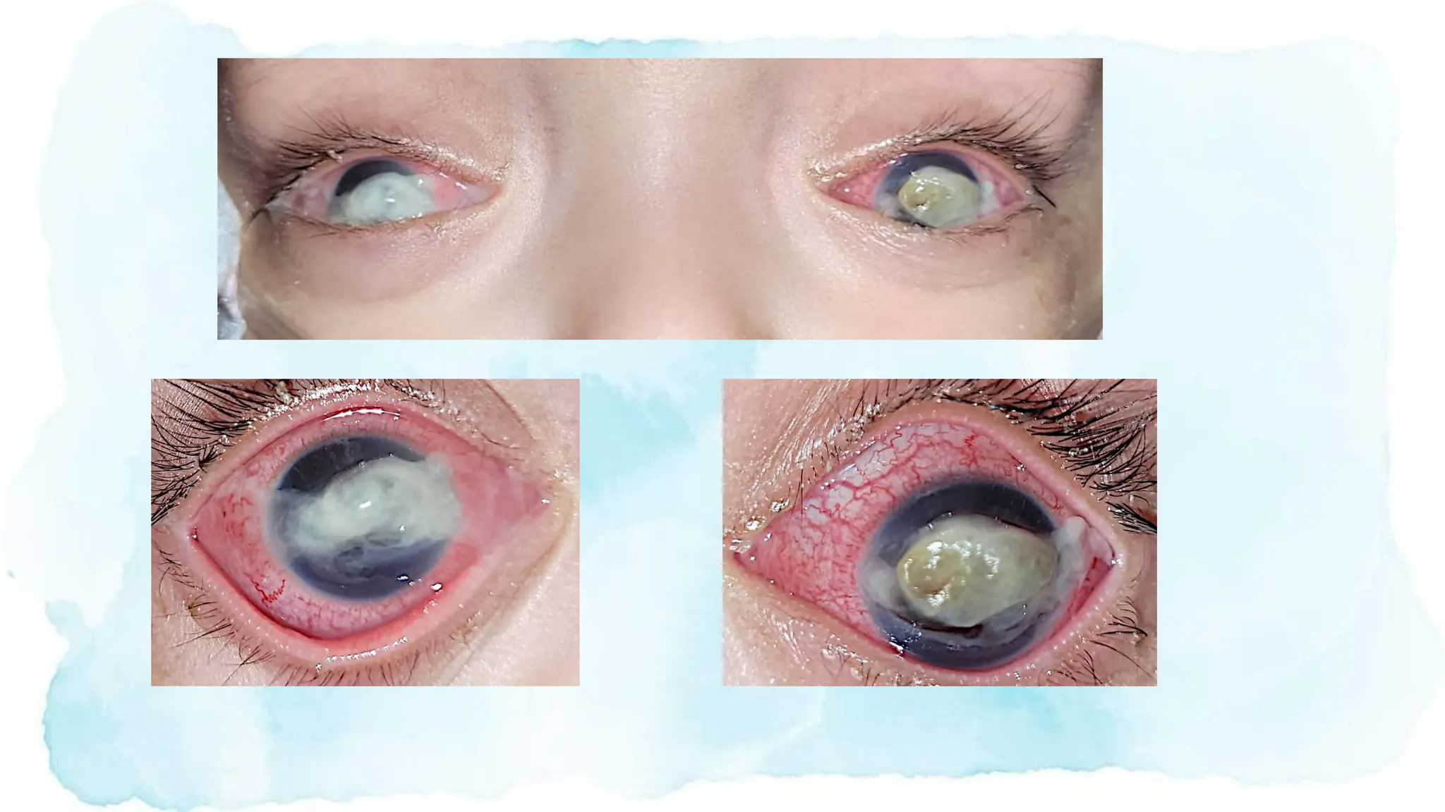 keratitis exposure done.pptx keratitis exposure | PPTX