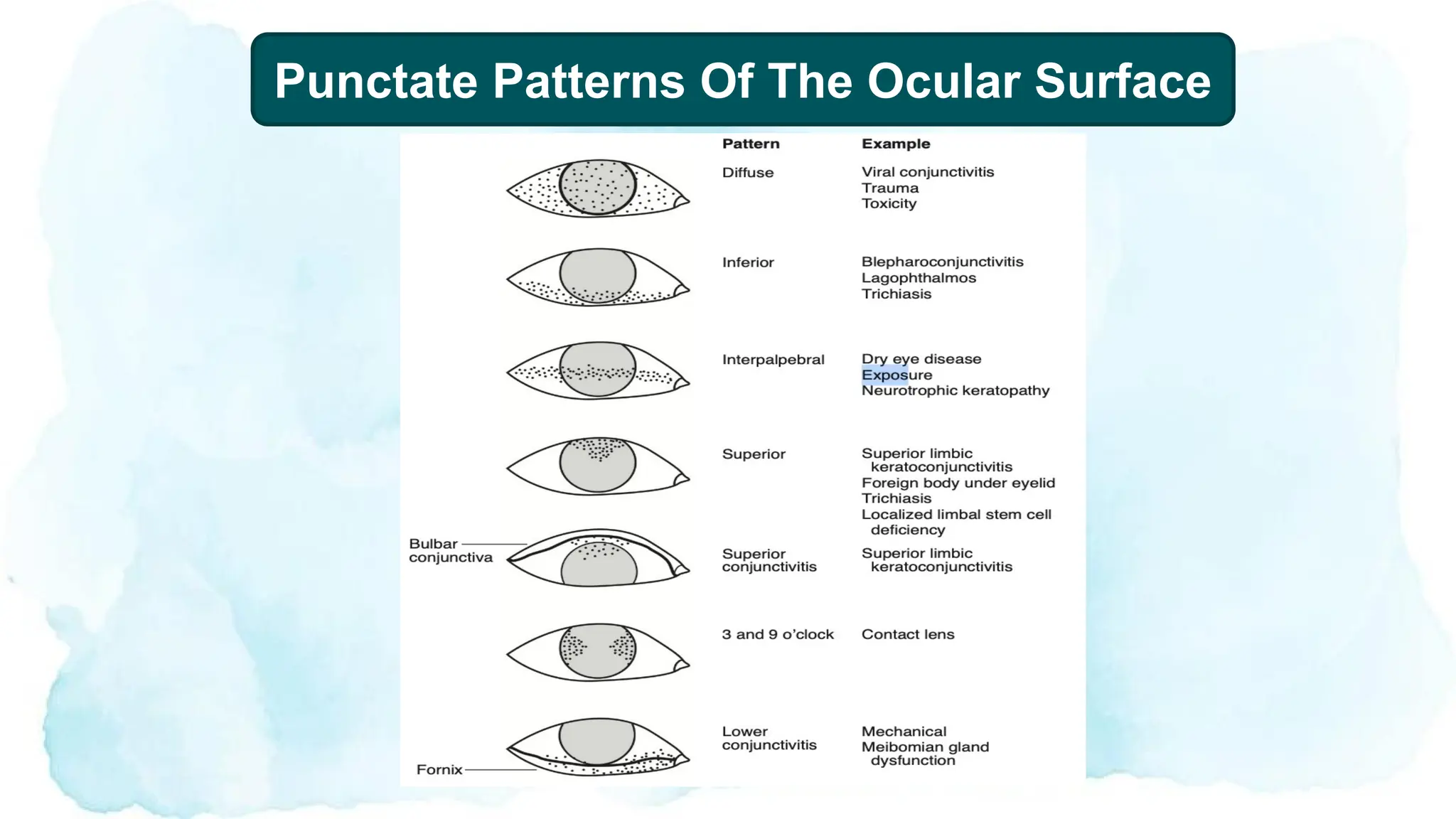 keratitis exposure done.pptx keratitis exposure | PPTX