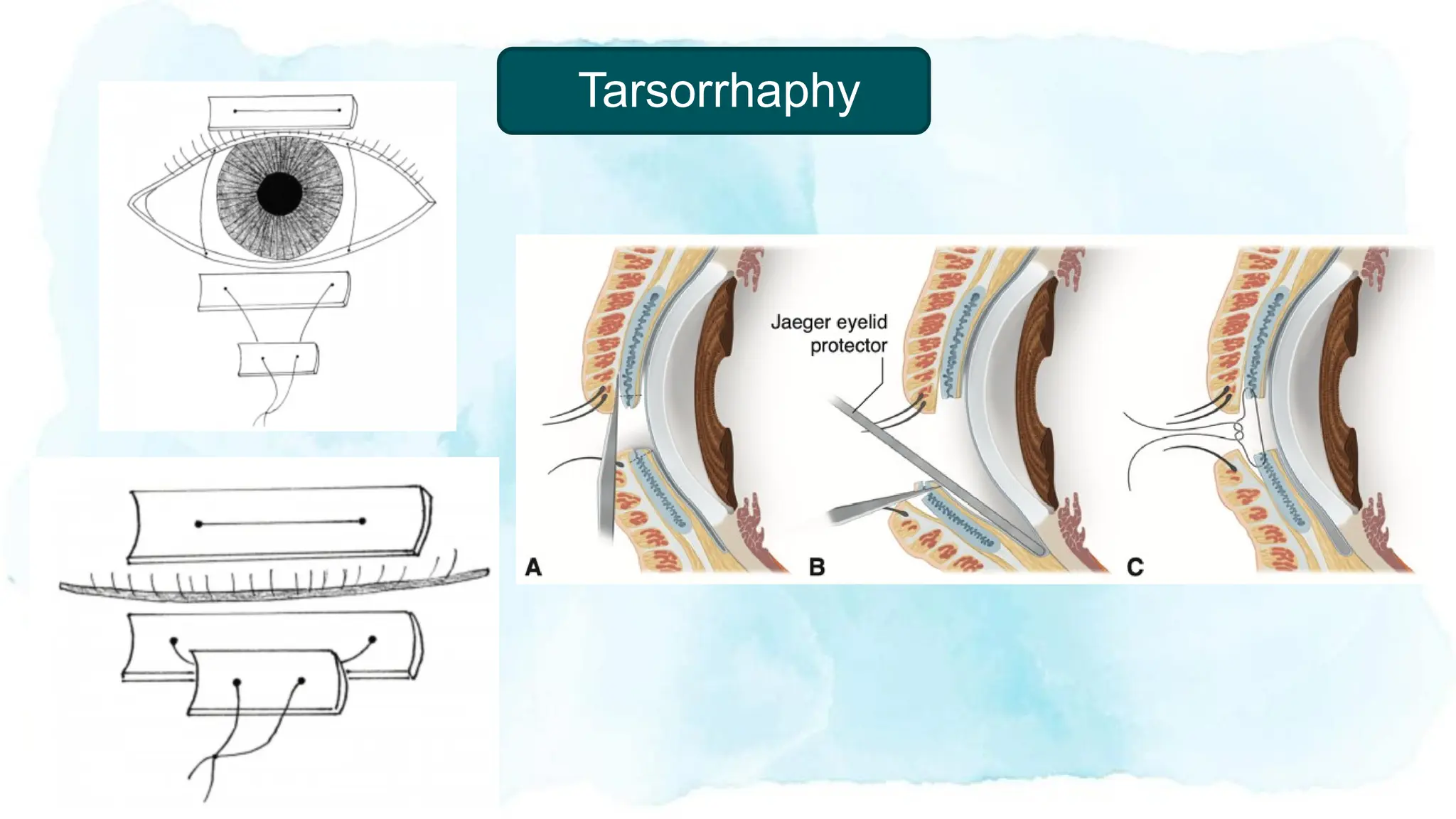 keratitis exposure done.pptx keratitis exposure | PPTX