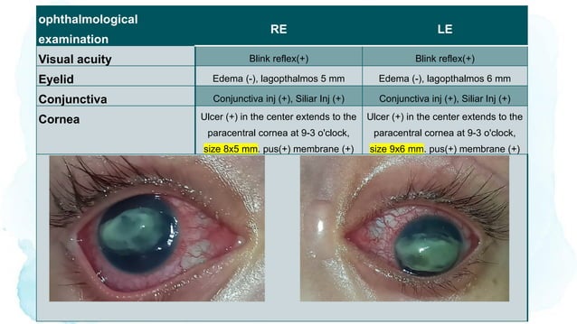 keratitis exposure done.pptx keratitis exposure | PPTX