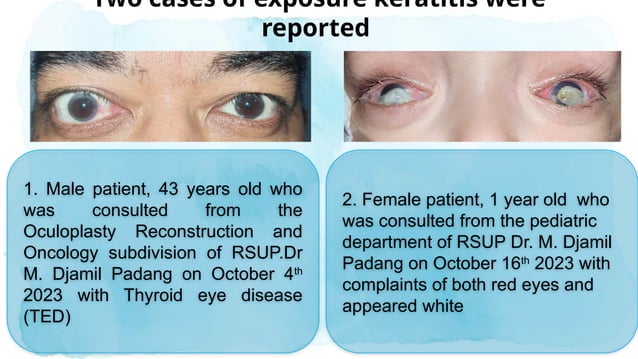 keratitis exposure done.pptx keratitis exposure | PPTX