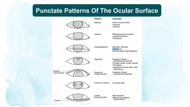 keratitis exposure done.pptx keratitis exposure | PPTX