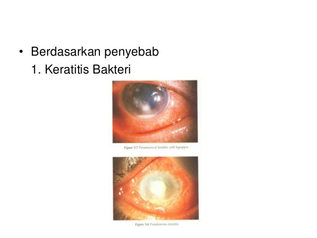 Keratitis mata