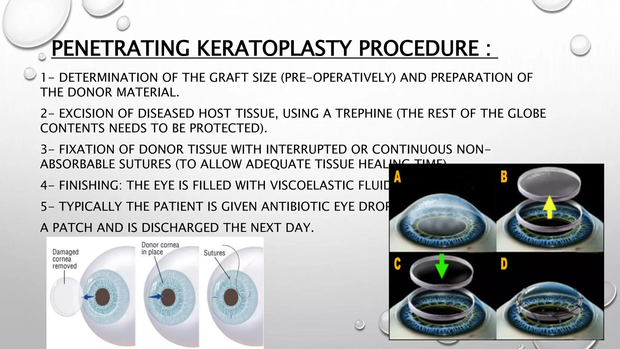 Keratoplasty | PPTX