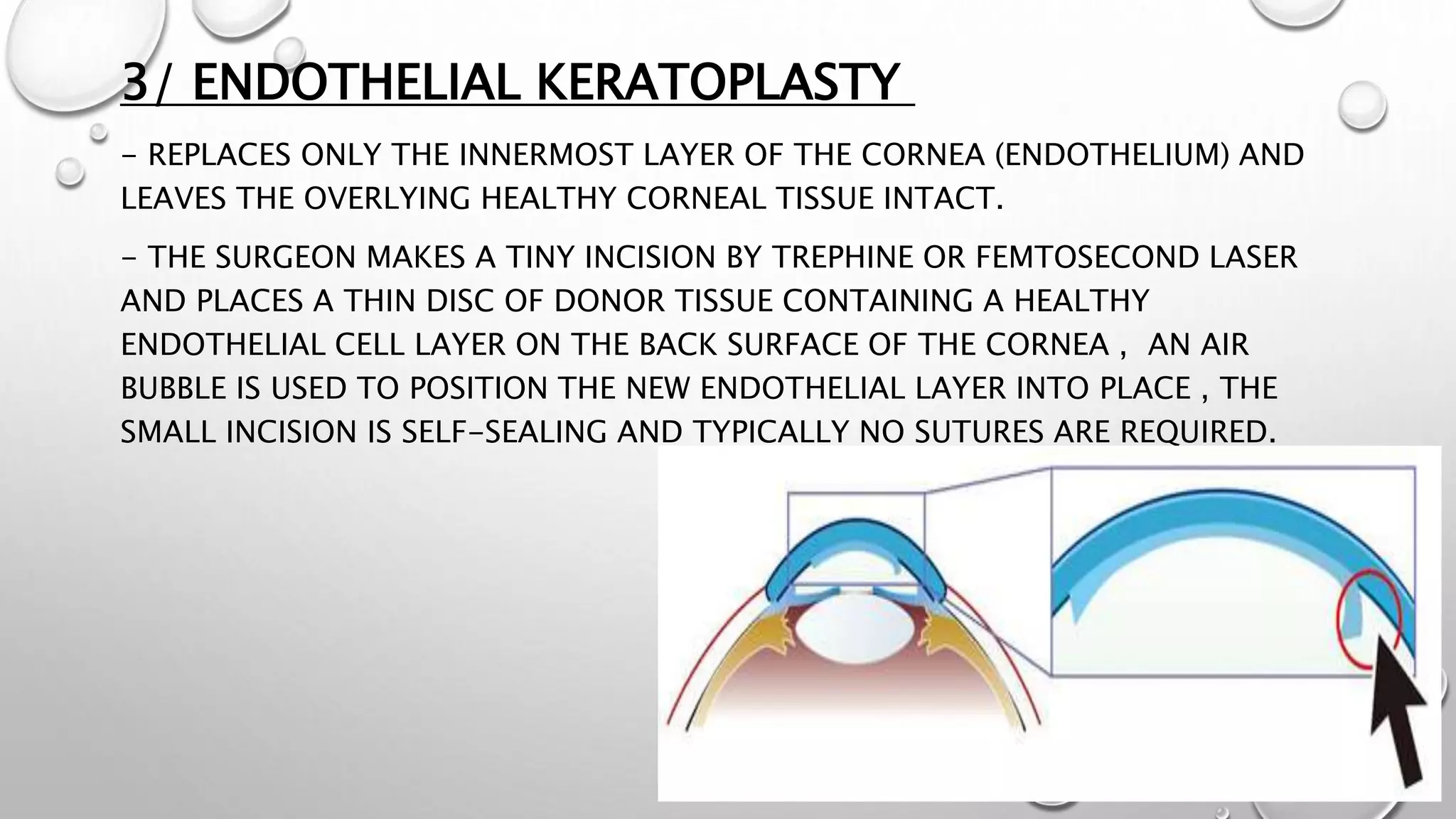 Keratoplasty | PPTX