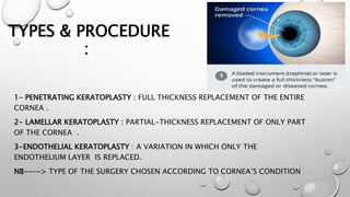 Keratoplasty | PPTX