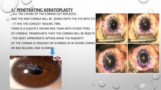 Keratoplasty | PPTX