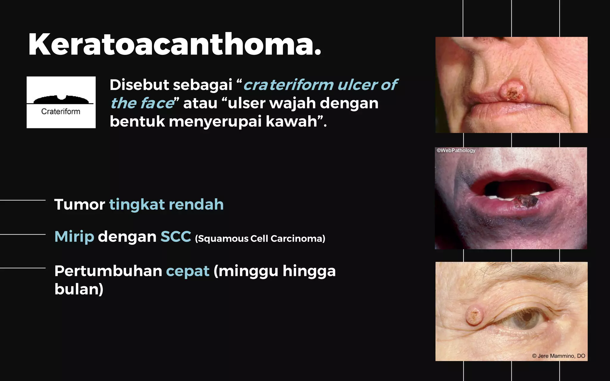 Keratoacanthoma of the tongue, a very unusual histopathology diagnosis with immunohistochemical ...