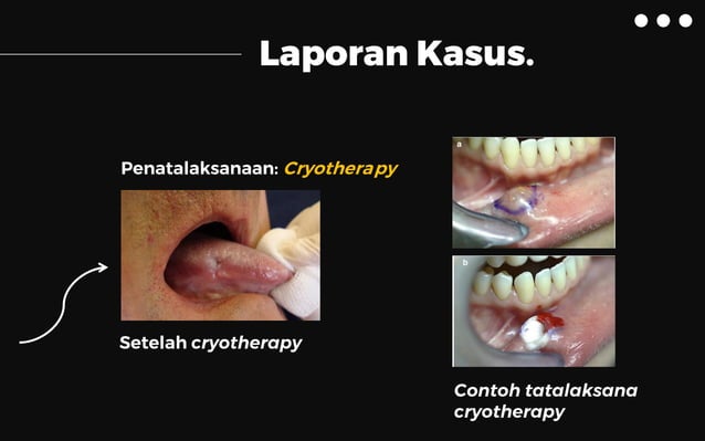 Keratoacanthoma of the tongue, a very unusual histopathology diagnosis with immunohistochemical ...