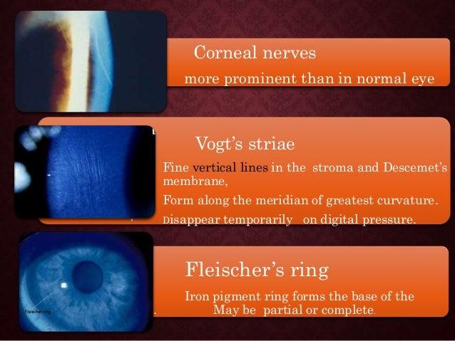 Keratoconus
