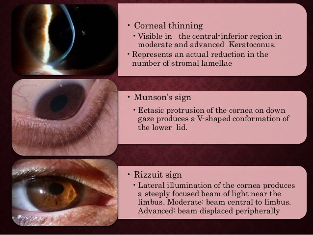 Keratoconus