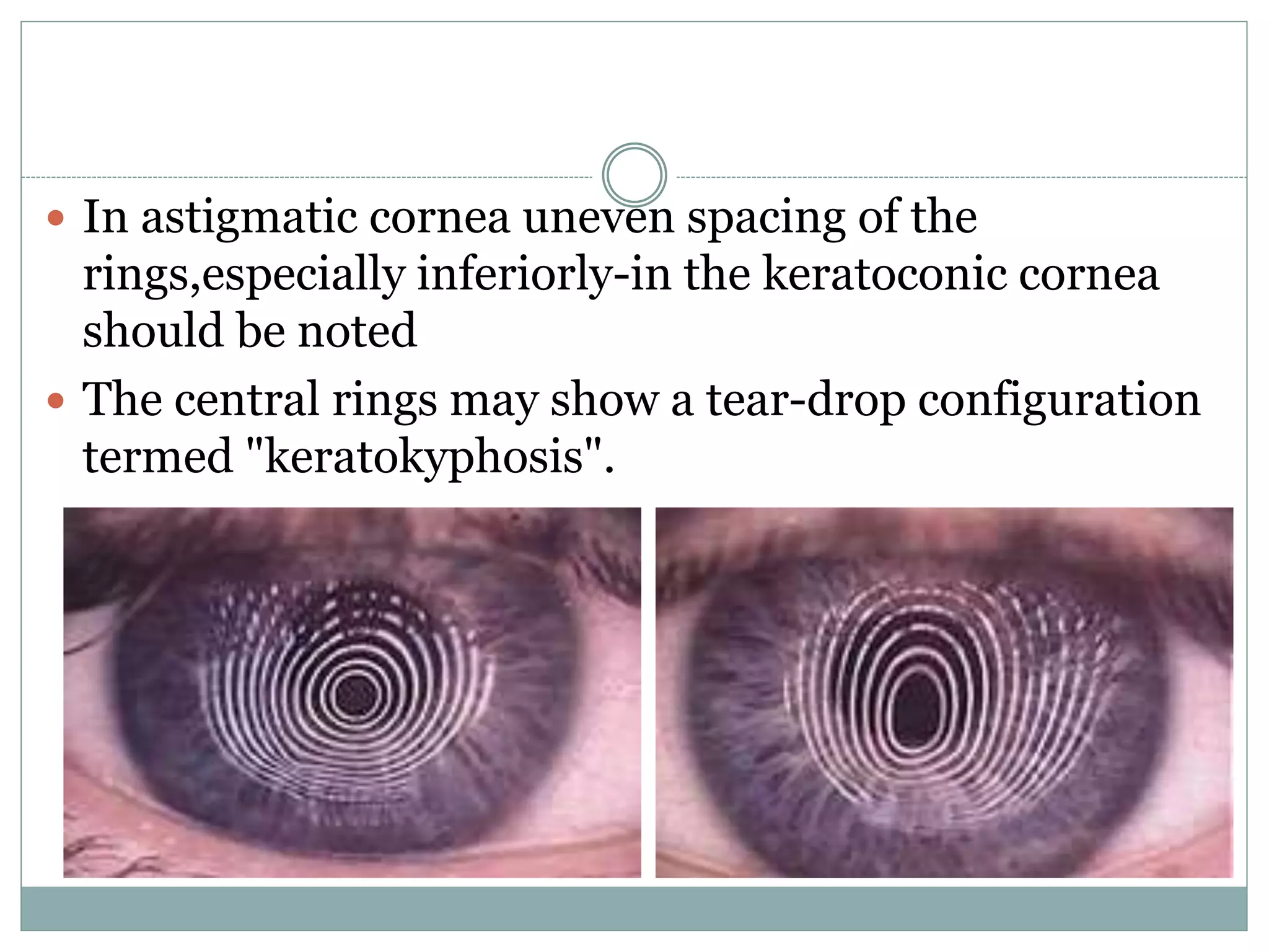 Keratoconus | PPTX