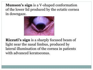 Keratoconus | PPTX