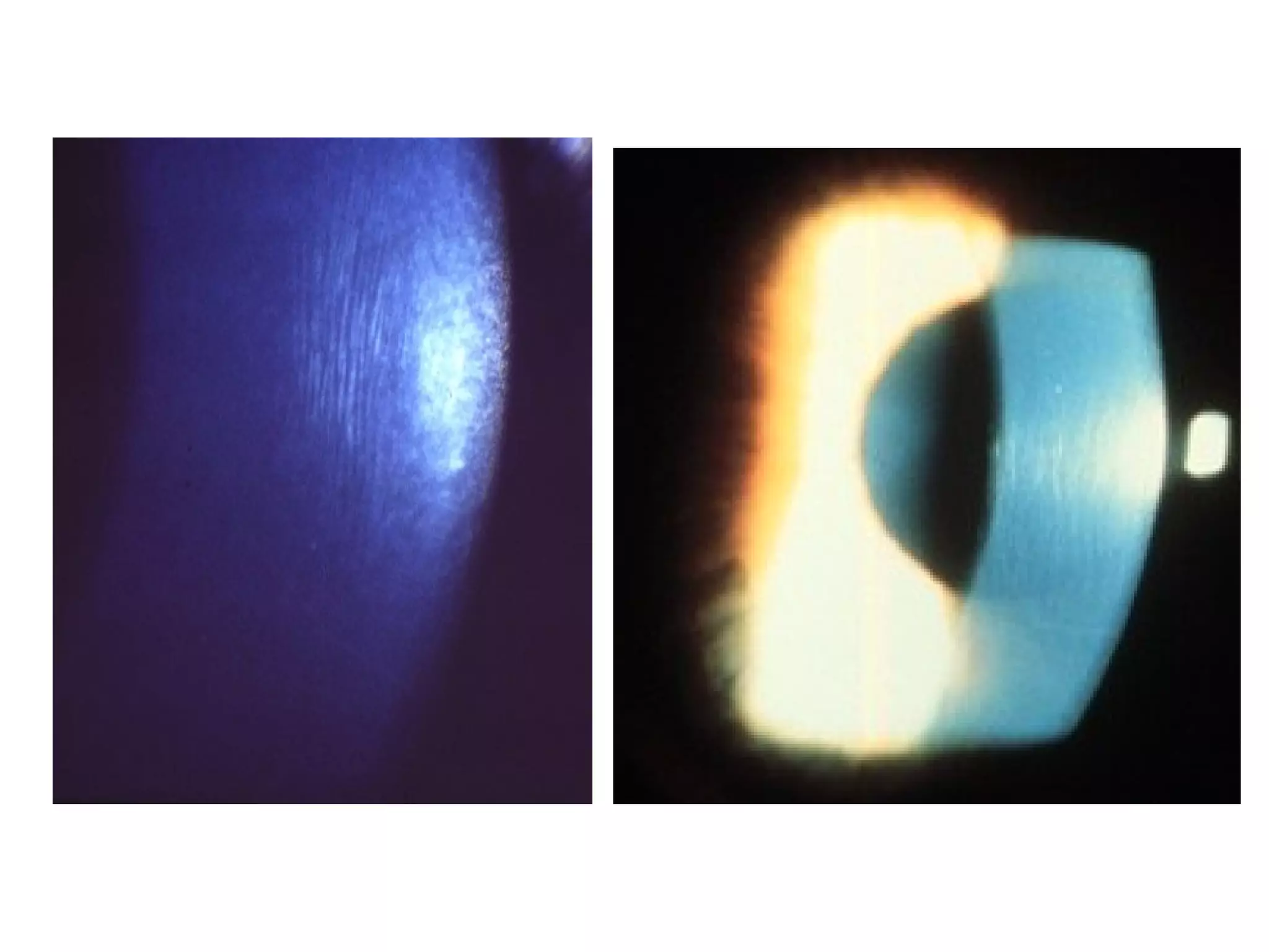 Keratoconus | PPT
