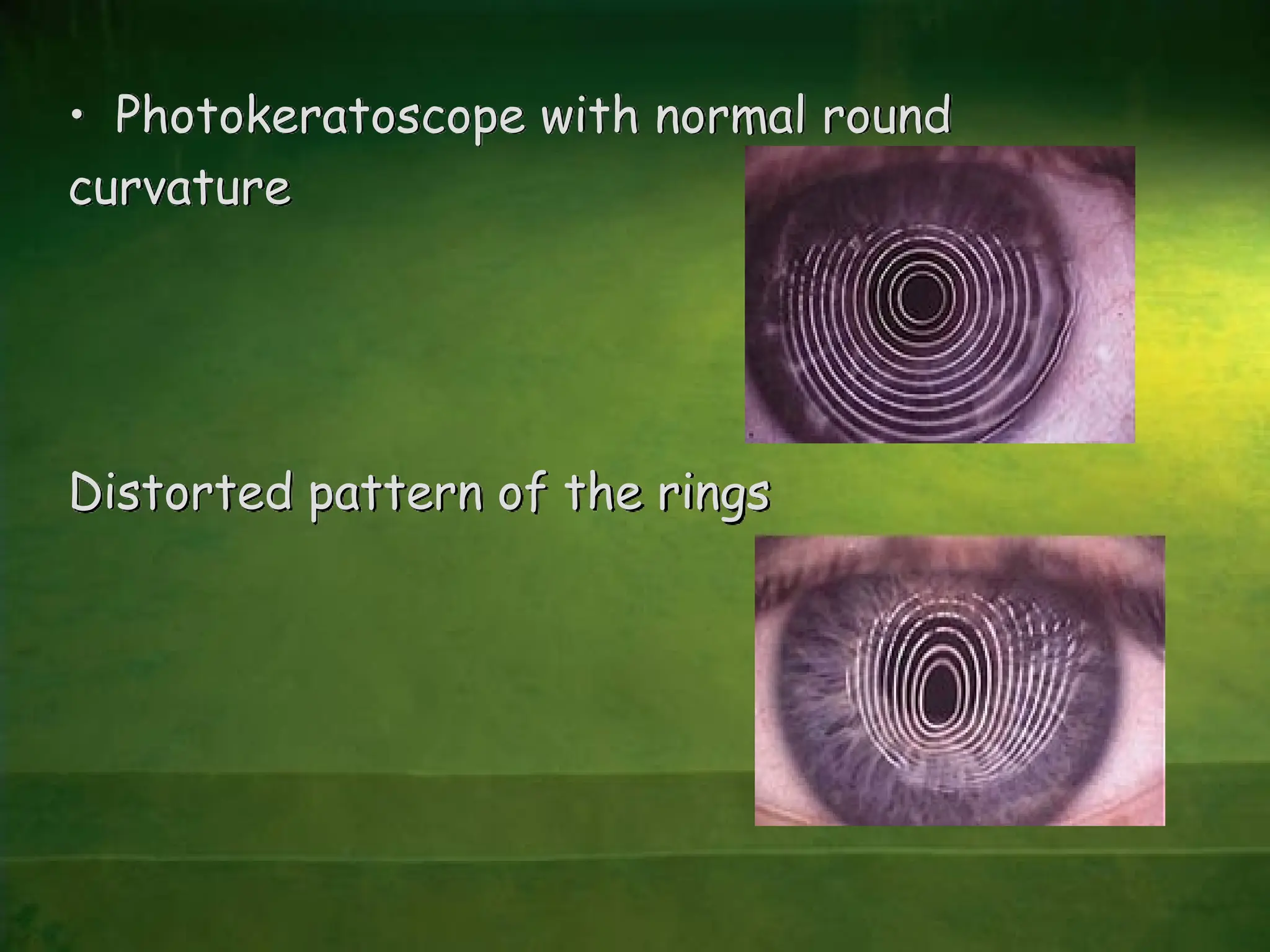 keratoconus presentation and treatment ppt | PPT