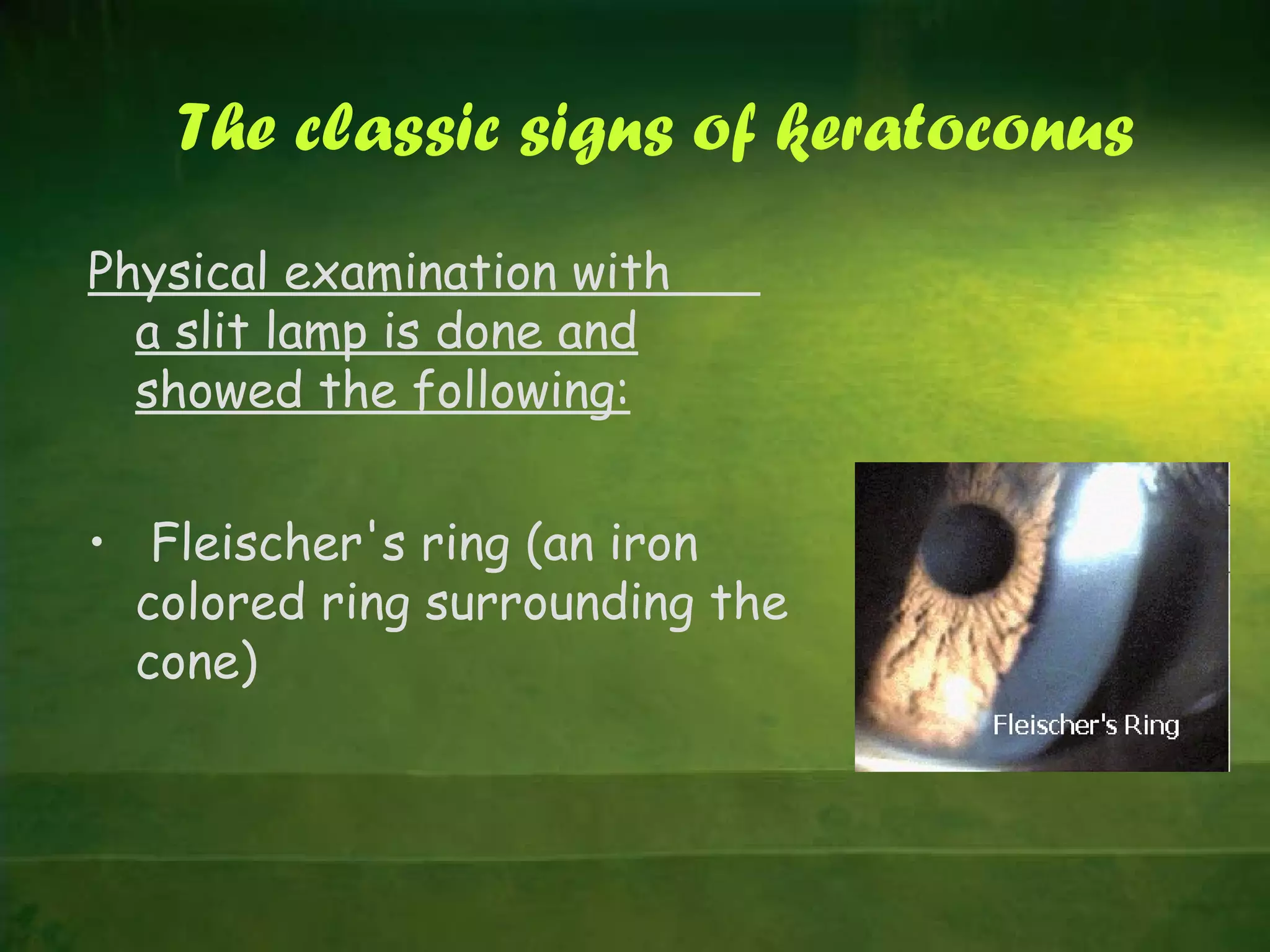 Keratoconus | PPT