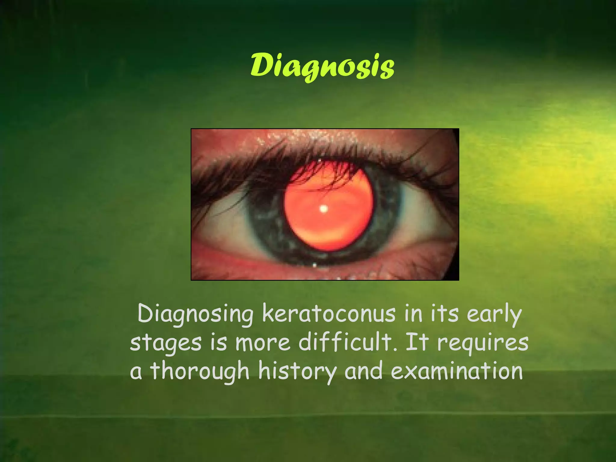 Keratoconus | PPT