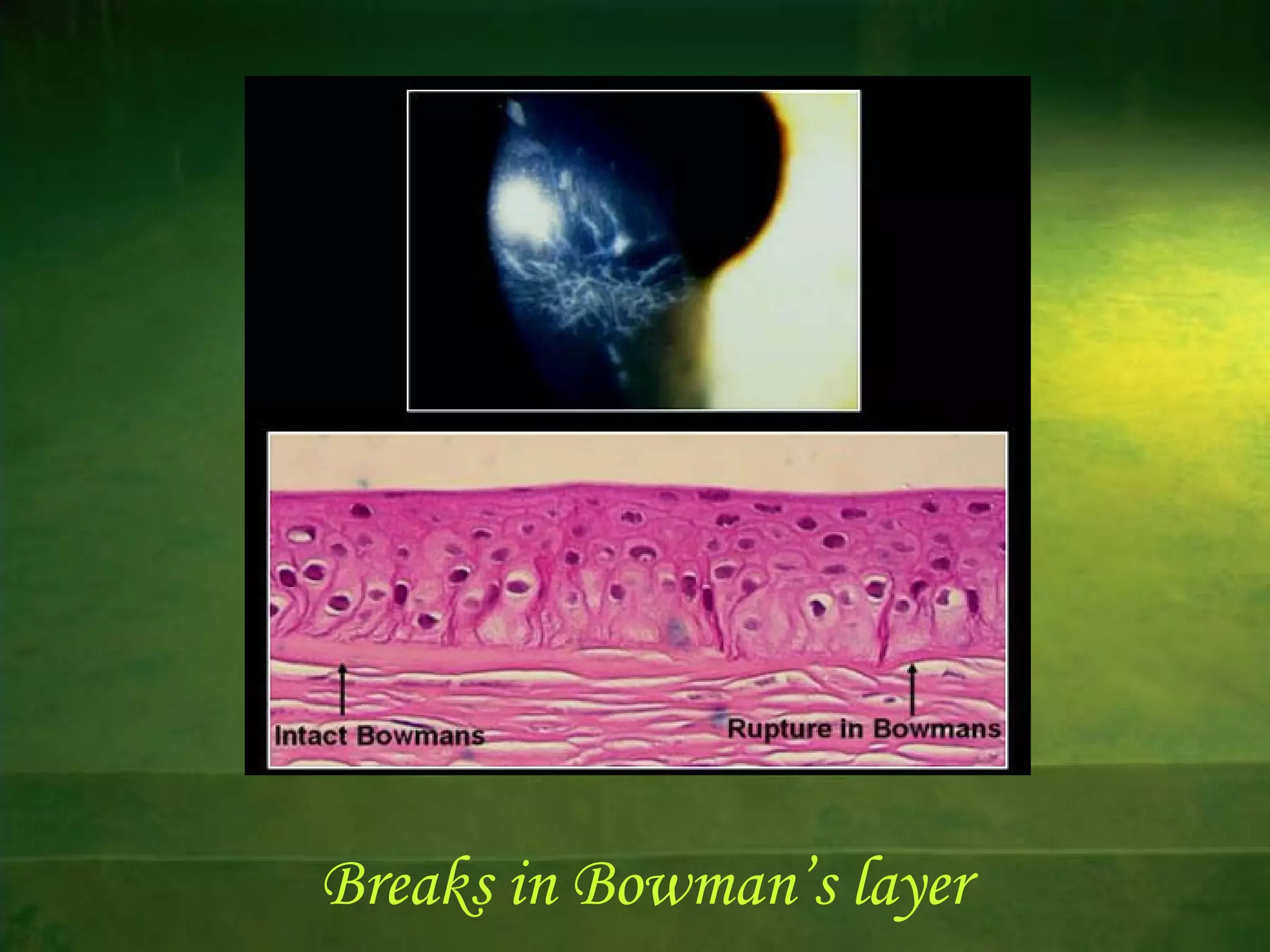 Keratoconus | PPT