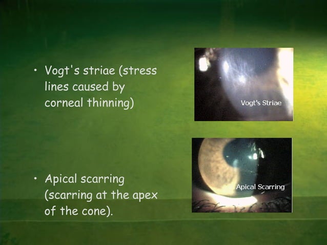 Keratoconus | PPT | Eye and Vision Conditions | Diseases and Conditions