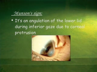 Keratoconus | PPT