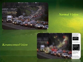Keratoconus | PPT