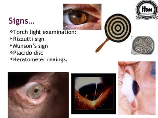 Keratoconus... | PPT
